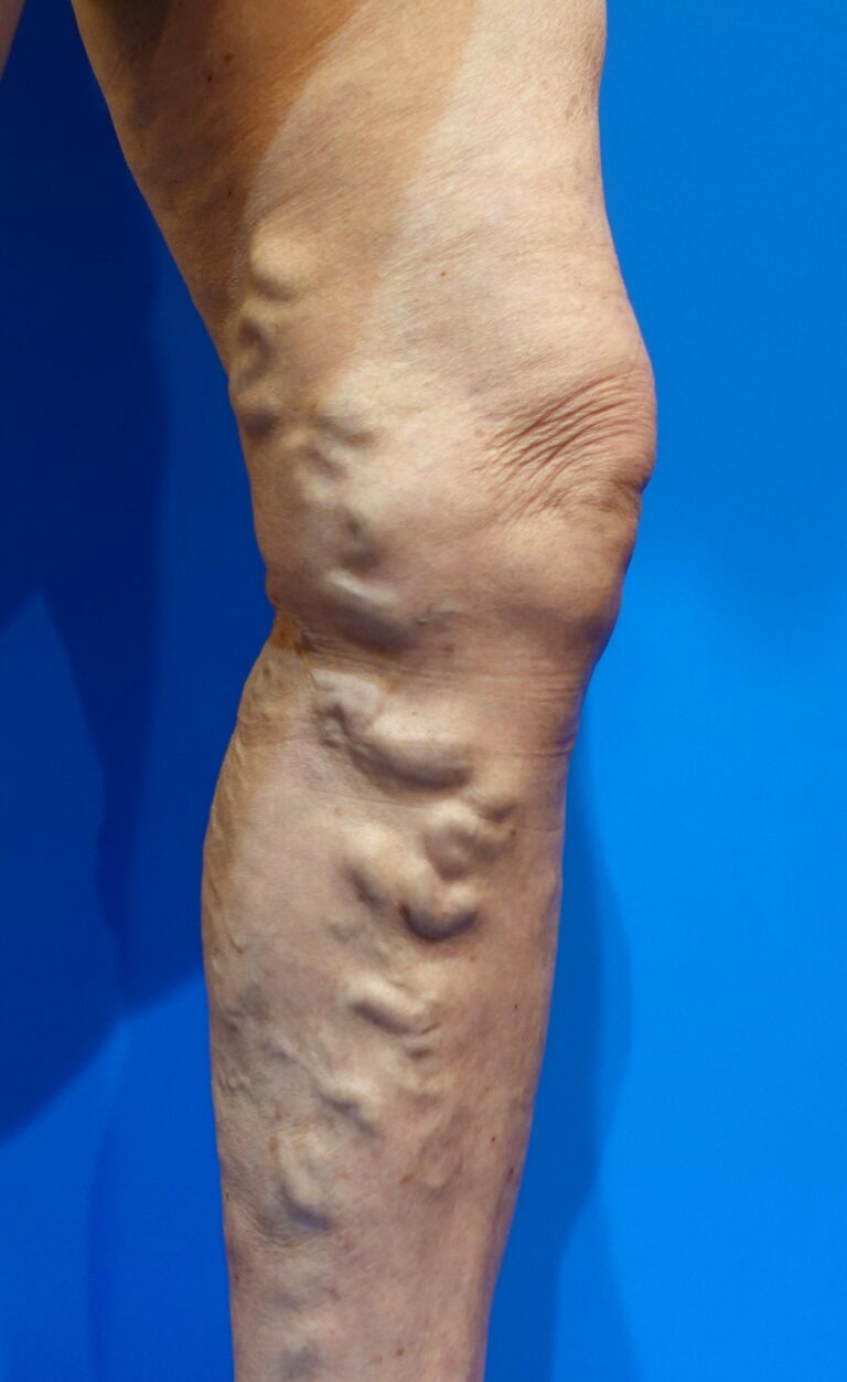 If you have leg wounds that are difficult to heal, you should suspect ...