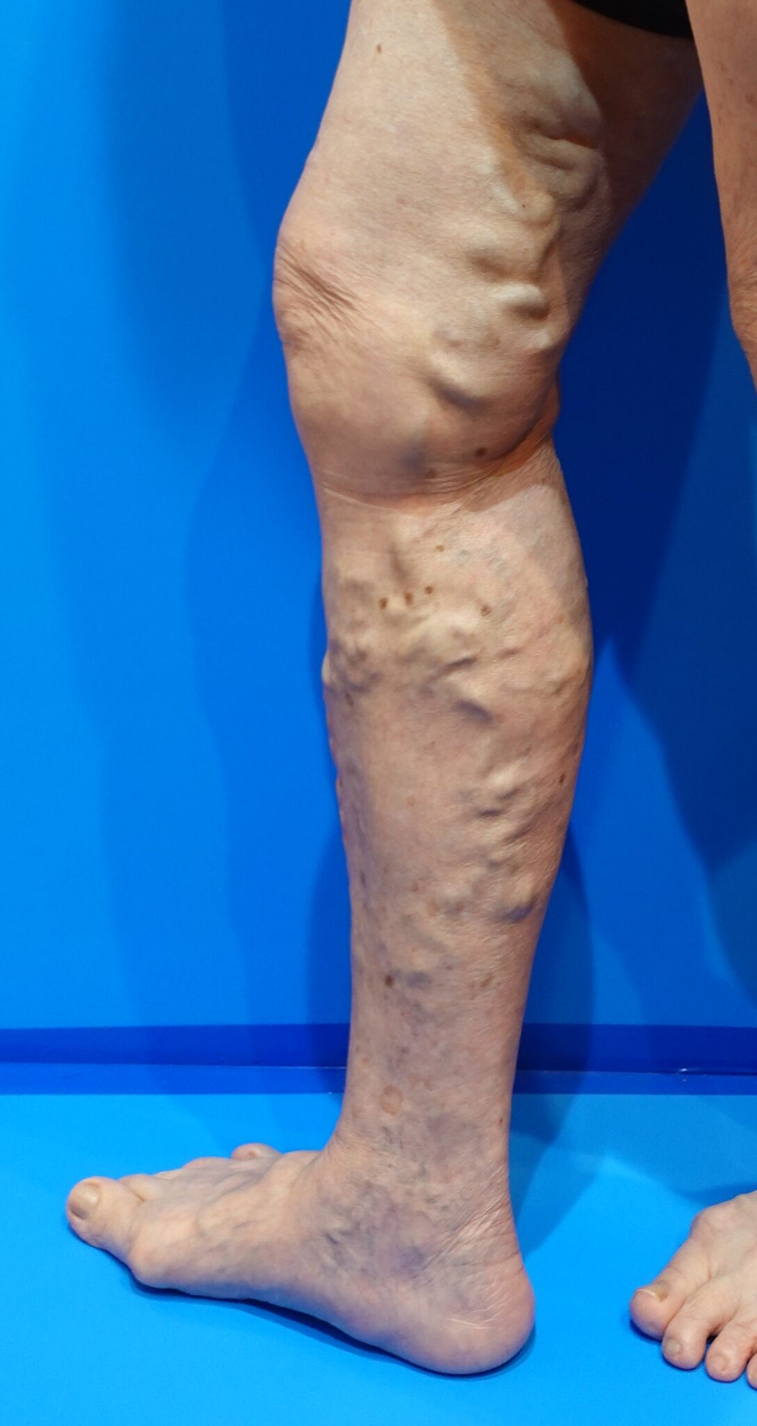 What Are Varicose Veins? A Guide to Symptoms and Treatments by Type ...