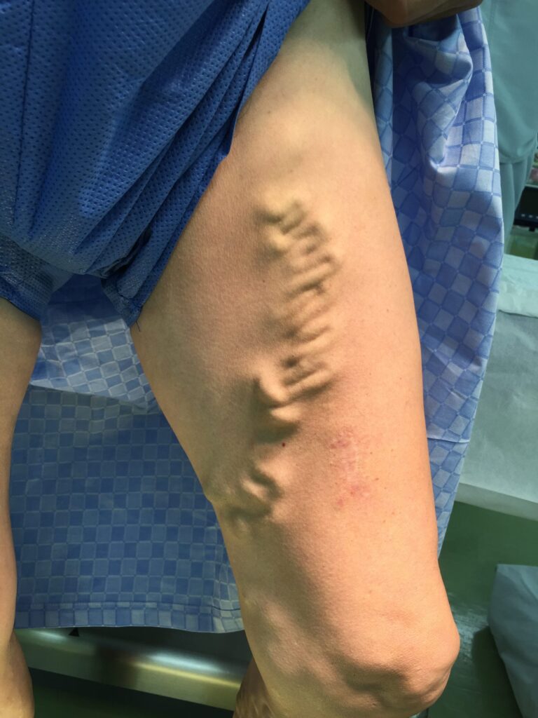 What Are Varicose Veins? A Clear Explanation with Photos | The Varicose ...